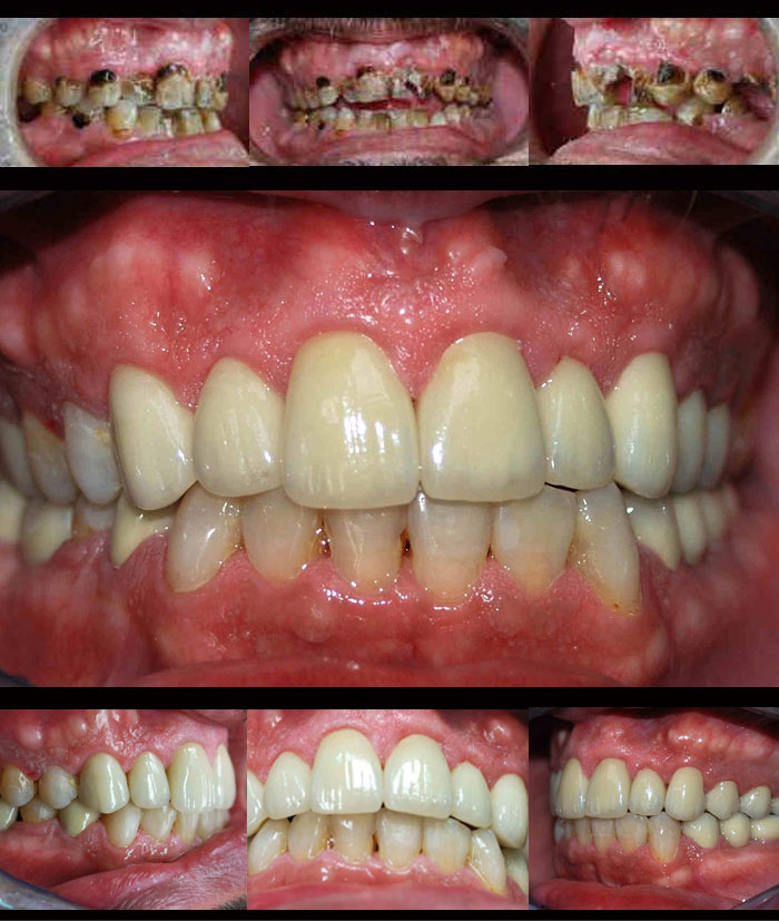 Caso de periodontitis y estética dental | Clínica dental en Gijón